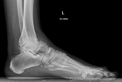 Artrosis de tobillo - Biclinic