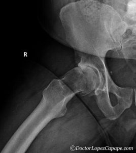 Artrosis de cadera (Coxartrosis) - Biclinic