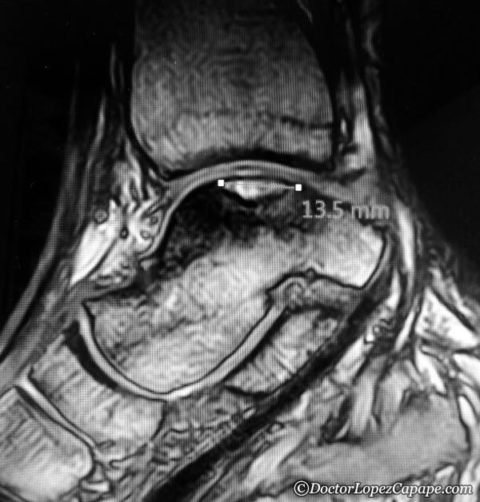 Esguince e inestabilidad de tobillo - Biclinic